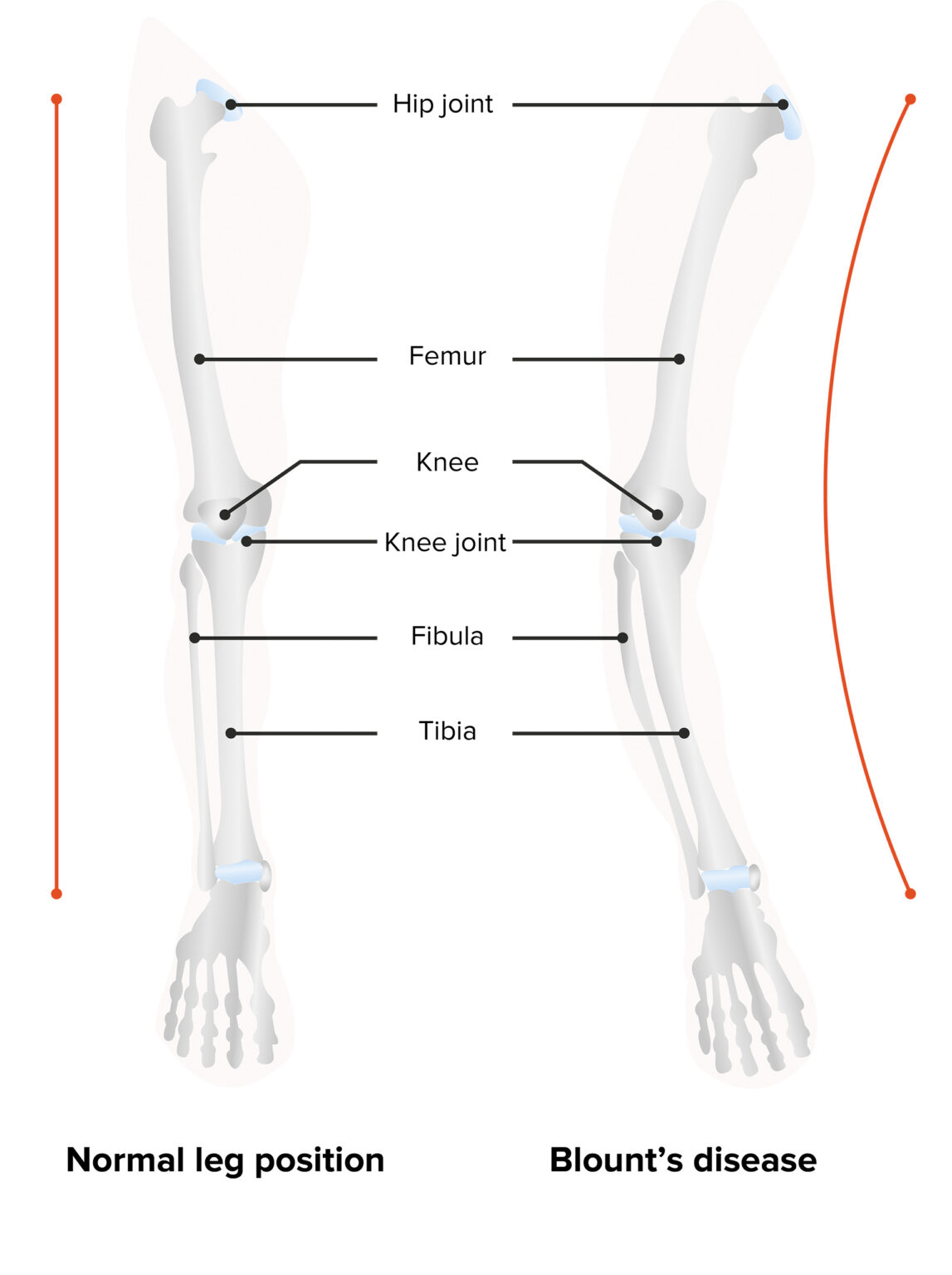Doença de Blount | Concise Medical Knowledge