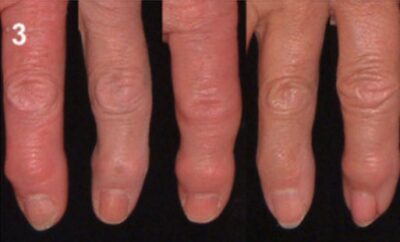 Osteoarthritis | Concise Medical Knowledge