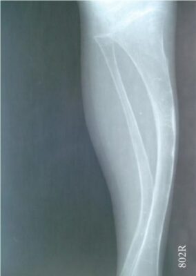 Osteogénesis Imperfecta | Concise Medical Knowledge