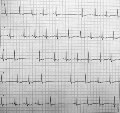 Bradyarrhythmias | Concise Medical Knowledge