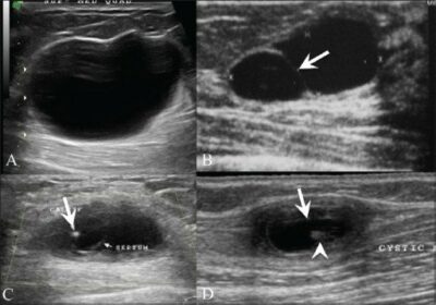 Benign Breast Conditions | Concise Medical Knowledge