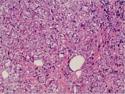 Cáncer de Mama | Concise Medical Knowledge