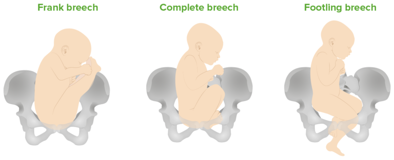 Presentación y Posición Fetal Anómalas | Concise Medical Knowledge