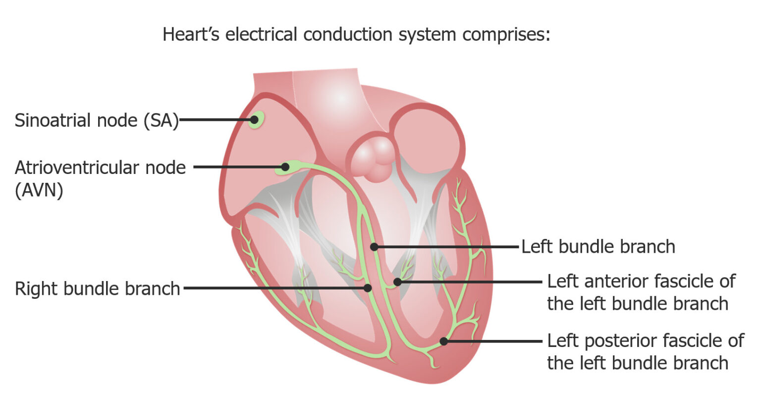 Bloqueos De Rama Y Fasciculares Concise Medical Knowledge