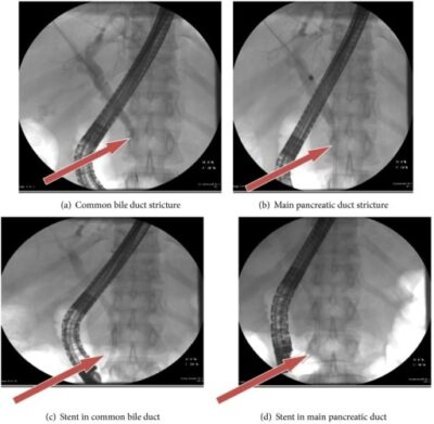 Chronic Pancreatitis | Concise Medical Knowledge