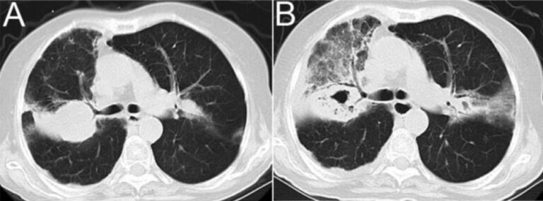 Nocardia/Nocardiosis | Concise Medical Knowledge
