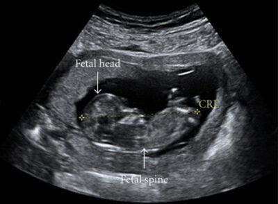 Restrição do Crescimento Fetal | Concise Medical Knowledge