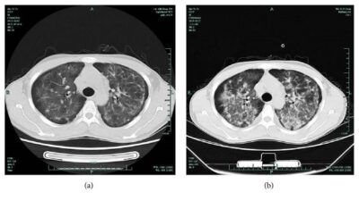 Pneumocystis jirovecii/Pneumocystis Pneumonia (PCP) | Concise Medical ...