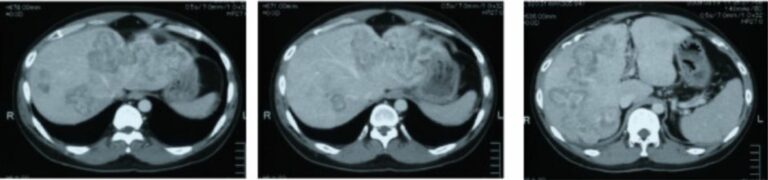 Colorectal Cancer | Concise Medical Knowledge