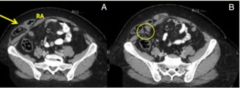 Abdominal Hernias | Concise Medical Knowledge