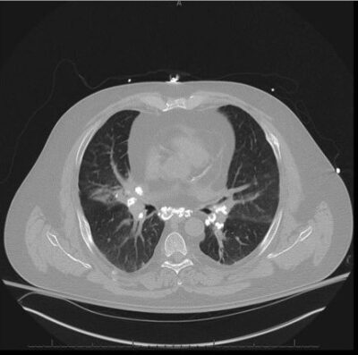 Sarcoidosis | Concise Medical Knowledge