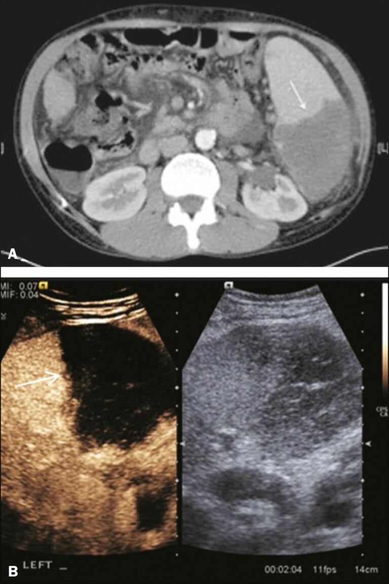 Imaging of the Spleen | Concise Medical Knowledge