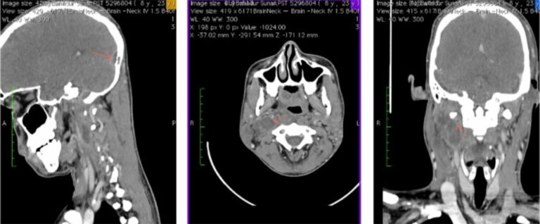 Parapharyngeal Abscess | Concise Medical Knowledge