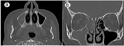 Sinusitis | Concise Medical Knowledge