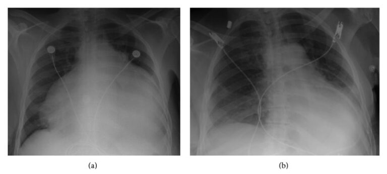 Pericardial Effusion And Cardiac Tamponade Concise Medical Knowledge