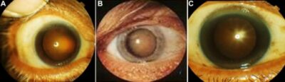 Cataracts in Adults | Concise Medical Knowledge