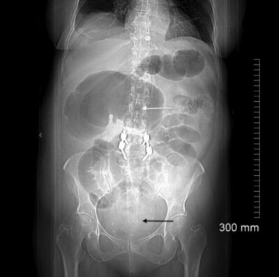 Vólvulo | Concise Medical Knowledge