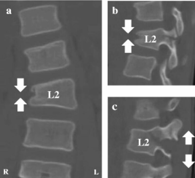 Imaging of the Spine and Spinal Cord | Concise Medical Knowledge