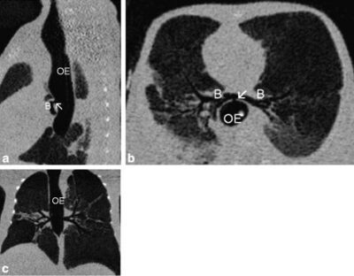 Atresia Anorrectal | Concise Medical Knowledge