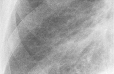 Pneumoconiose | Concise Medical Knowledge