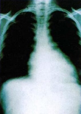 Trypanosoma cruzi/Chagas disease | Concise Medical Knowledge