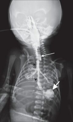 Esophageal Atresia and Tracheoesophageal Fistula | Concise Medical ...