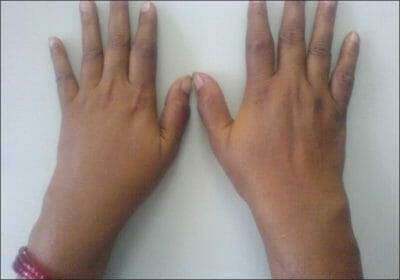 Chikungunya Virus | Concise Medical Knowledge
