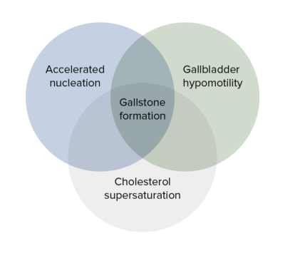 Cholelithiasis | Concise Medical Knowledge