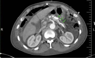 Chronic Pancreatitis | Concise Medical Knowledge