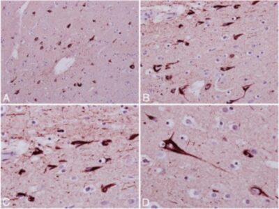 Cellular Accumulations | Concise Medical Knowledge