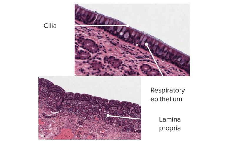 Primary Ciliary Dyskinesia | Concise Medical Knowledge