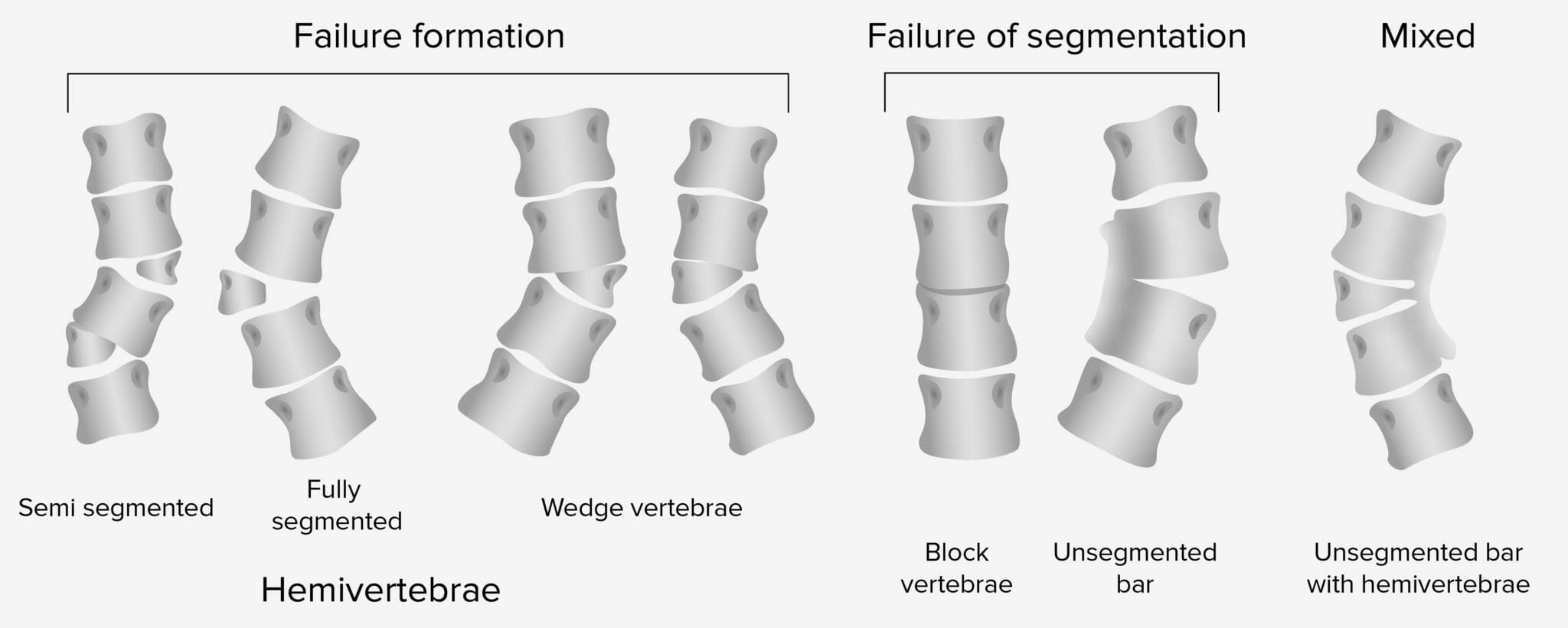 Scoliosis | Concise Medical Knowledge