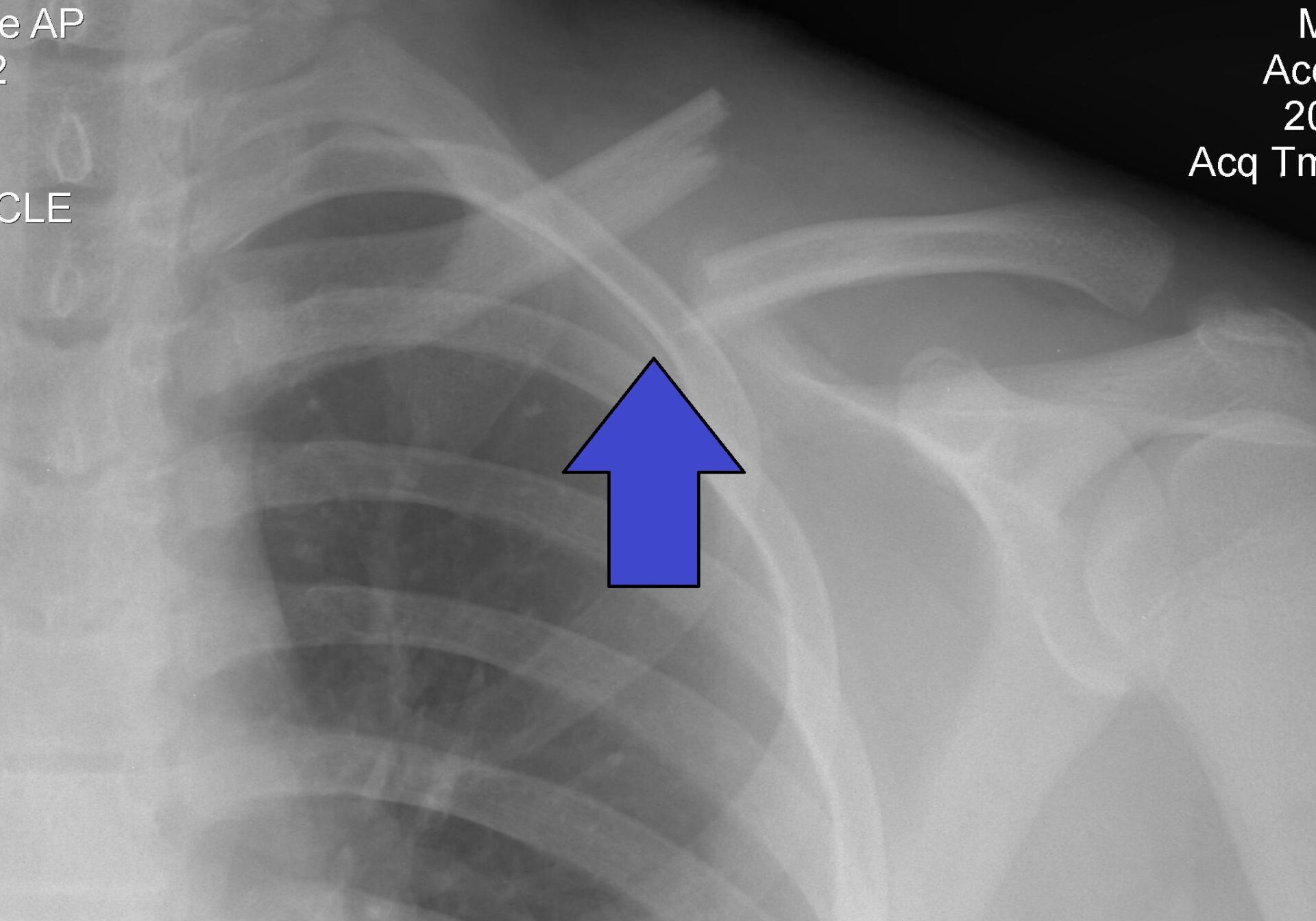 Acute Shoulder Pain | Concise Medical Knowledge
