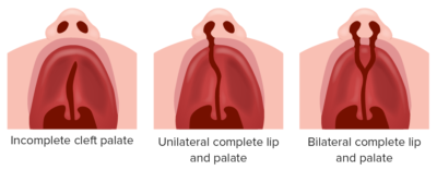 Cleft Lip and Cleft Palate | Concise Medical Knowledge