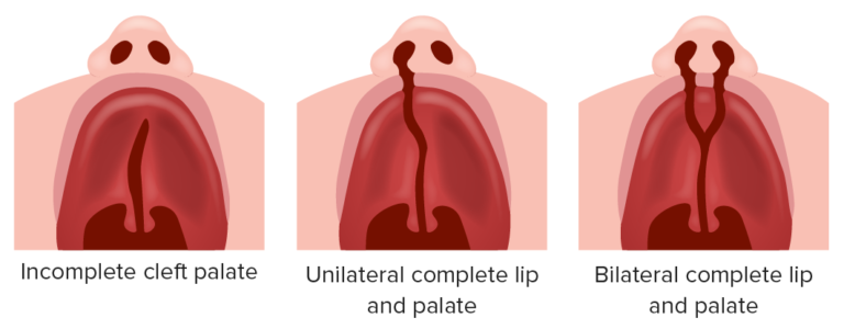 Cleft Lip and Cleft Palate | Concise Medical Knowledge