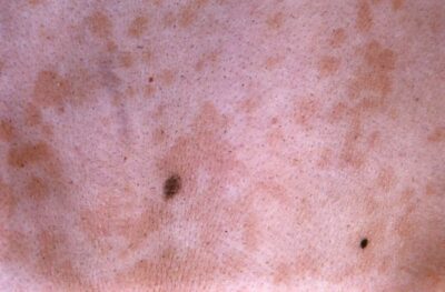 Malassezia Fungi | Concise Medical Knowledge