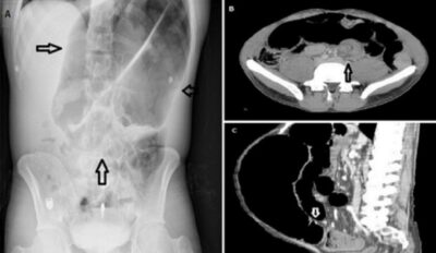 Volvulus | Concise Medical Knowledge