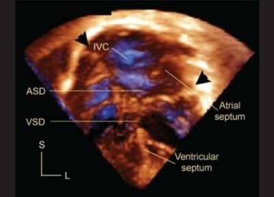 Atrioventricular Septal Defect (AVSD) | Concise Medical Knowledge