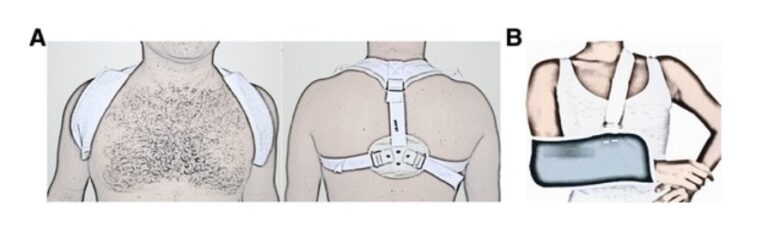 Clavicle Fracture | Concise Medical Knowledge