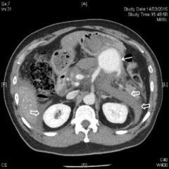 Pancreatitis aguda | Concise Medical Knowledge