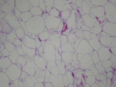 Lipomas | Concise Medical Knowledge