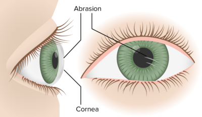 Abrasões, Erosões e Úlceras da Córnea | Concise Medical Knowledge