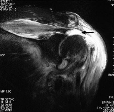 Chronic Shoulder Pain | Concise Medical Knowledge