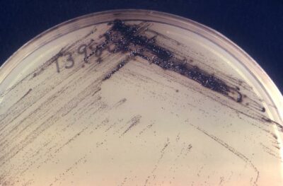 Difteria | Concise Medical Knowledge