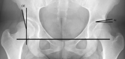 Developmental Dysplasia of the Hip | Concise Medical Knowledge