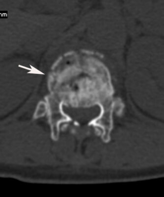 Imagenología de la Columna Vertebral y la Médula Espinal | Concise ...
