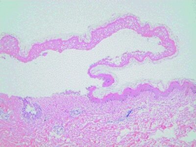Stevens-Johnson Syndrome | Concise Medical Knowledge