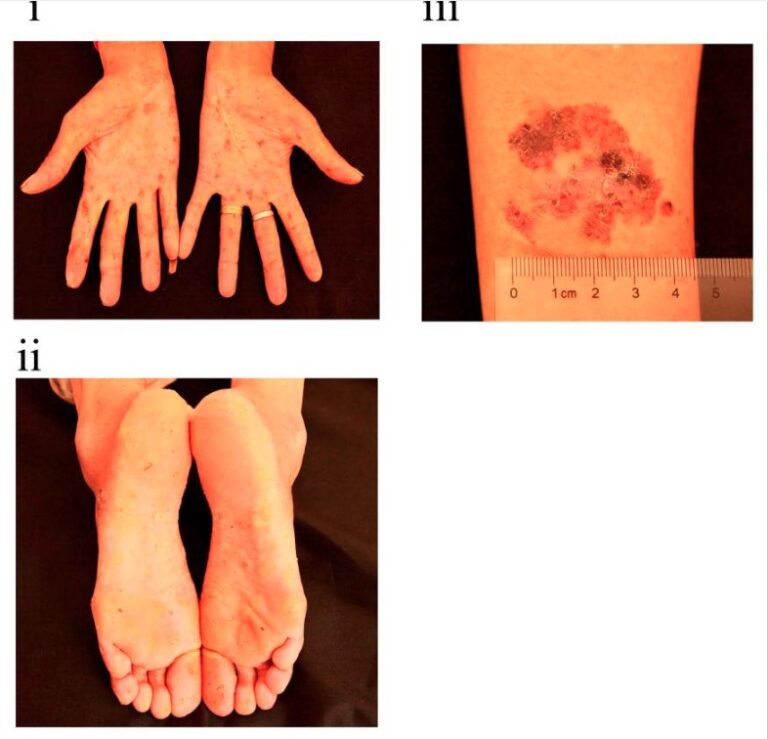 Intoxicação por Metais (Chumbo, Arsénio, Ferro) | Concise Medical Knowledge