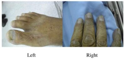 Methemoglobinemia | Concise Medical Knowledge