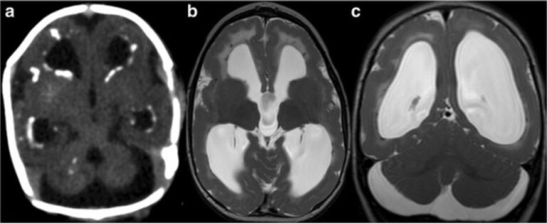 Cytomegalovirus | Concise Medical Knowledge